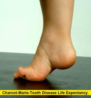 Charcot-Marie-Tooth Disease Life Expectancy: 2025 Updates on Prognosis ...