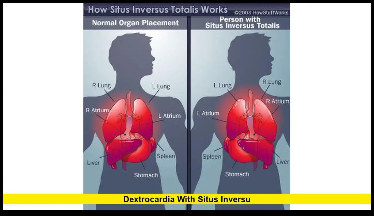 Dextrocardia With Situs Inversu: Current Medical Understanding and ...
